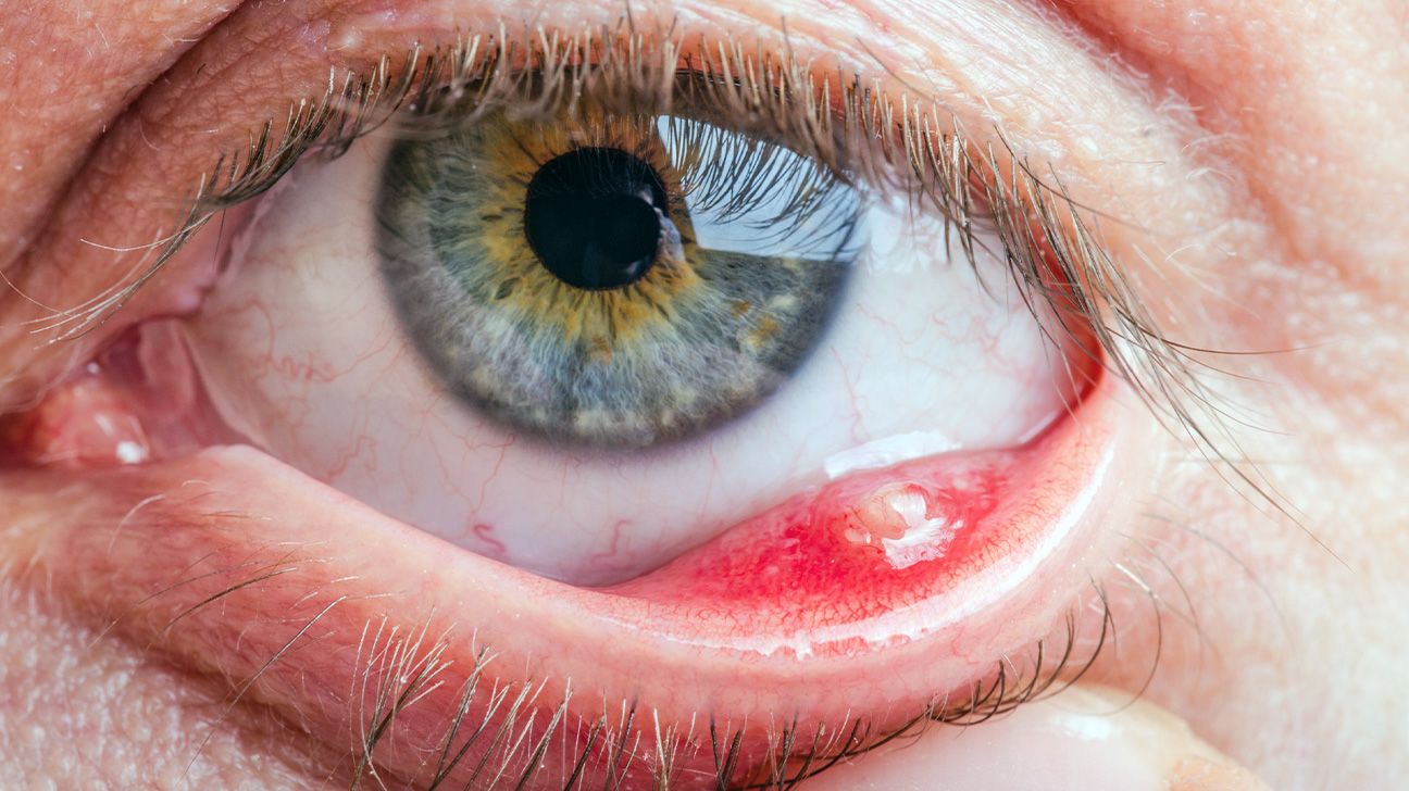What Causes A Stye STYE Ishwar Eye Centre