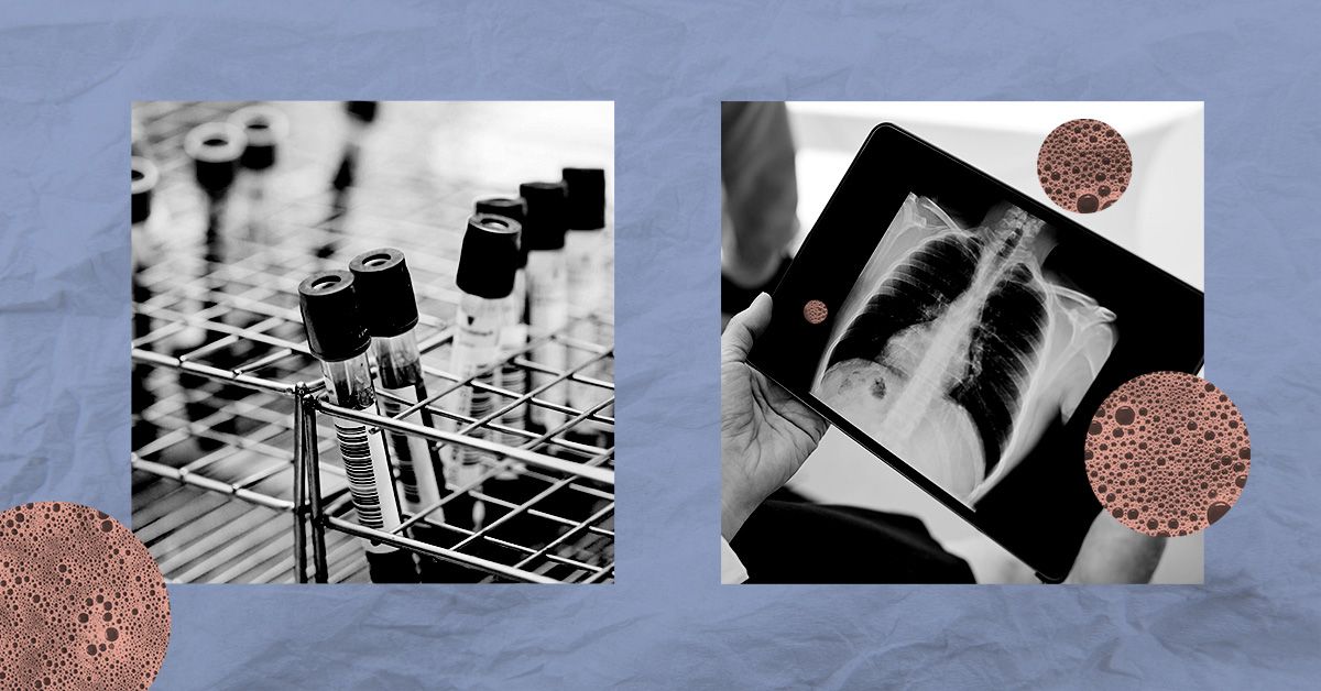 HIV and tuberculosis: Causes, symptoms, treatments, and more