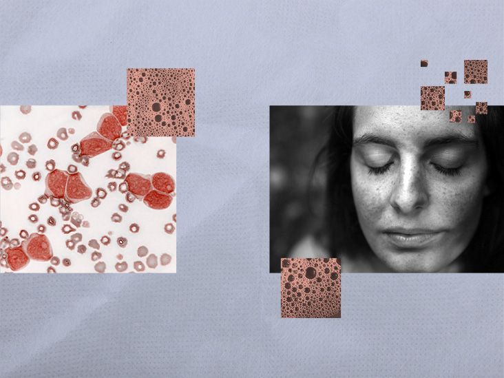 Myeloblast: Definition, related conditions, and more
