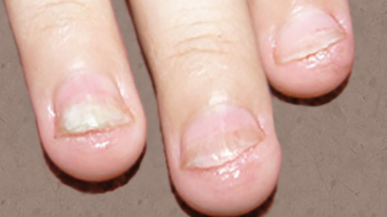 What does a yeast infection look like Examples and treatments