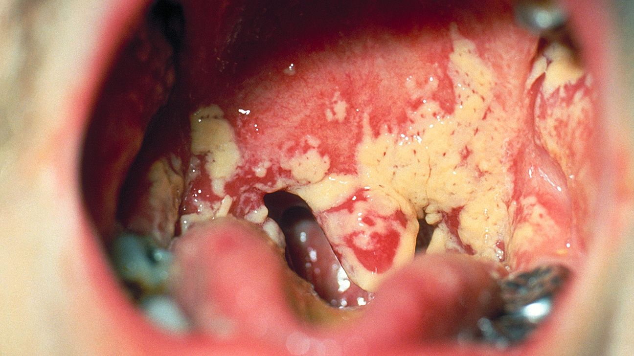 What is a yeast infection in a woman store