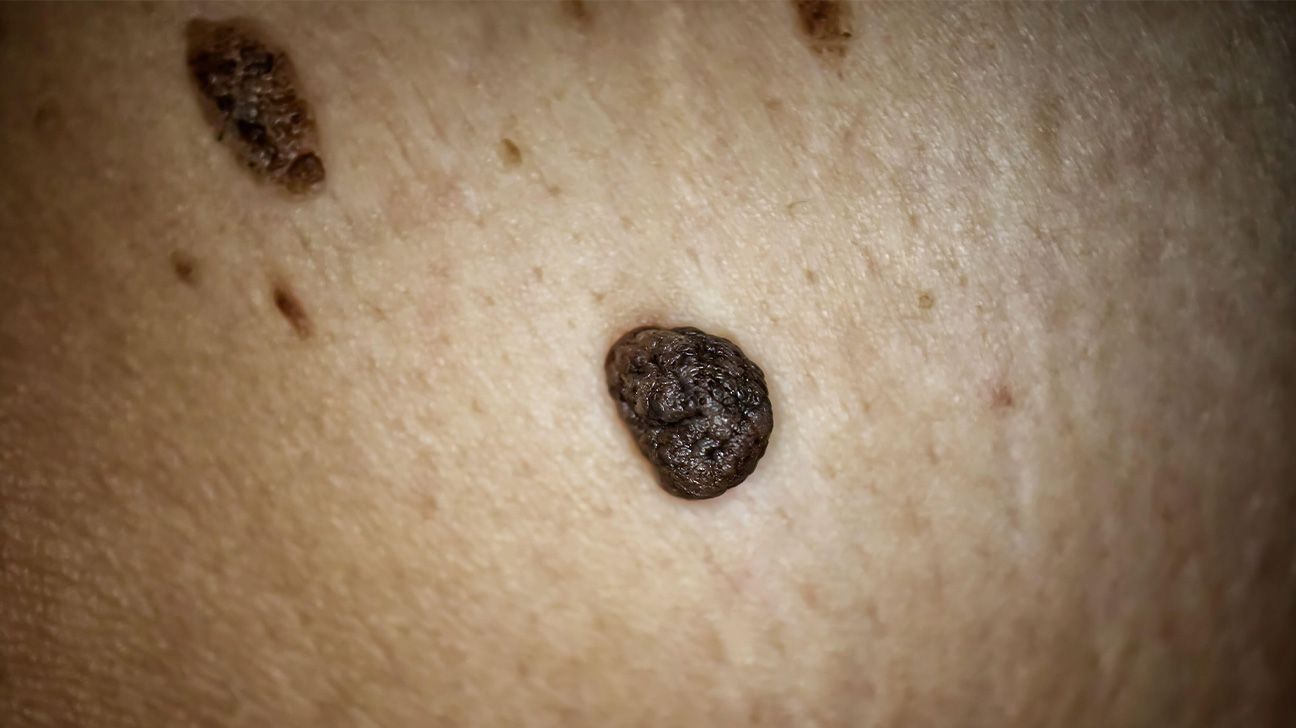 Difference Between Old Age Spots And Skin Cancer - Infoupdate.org