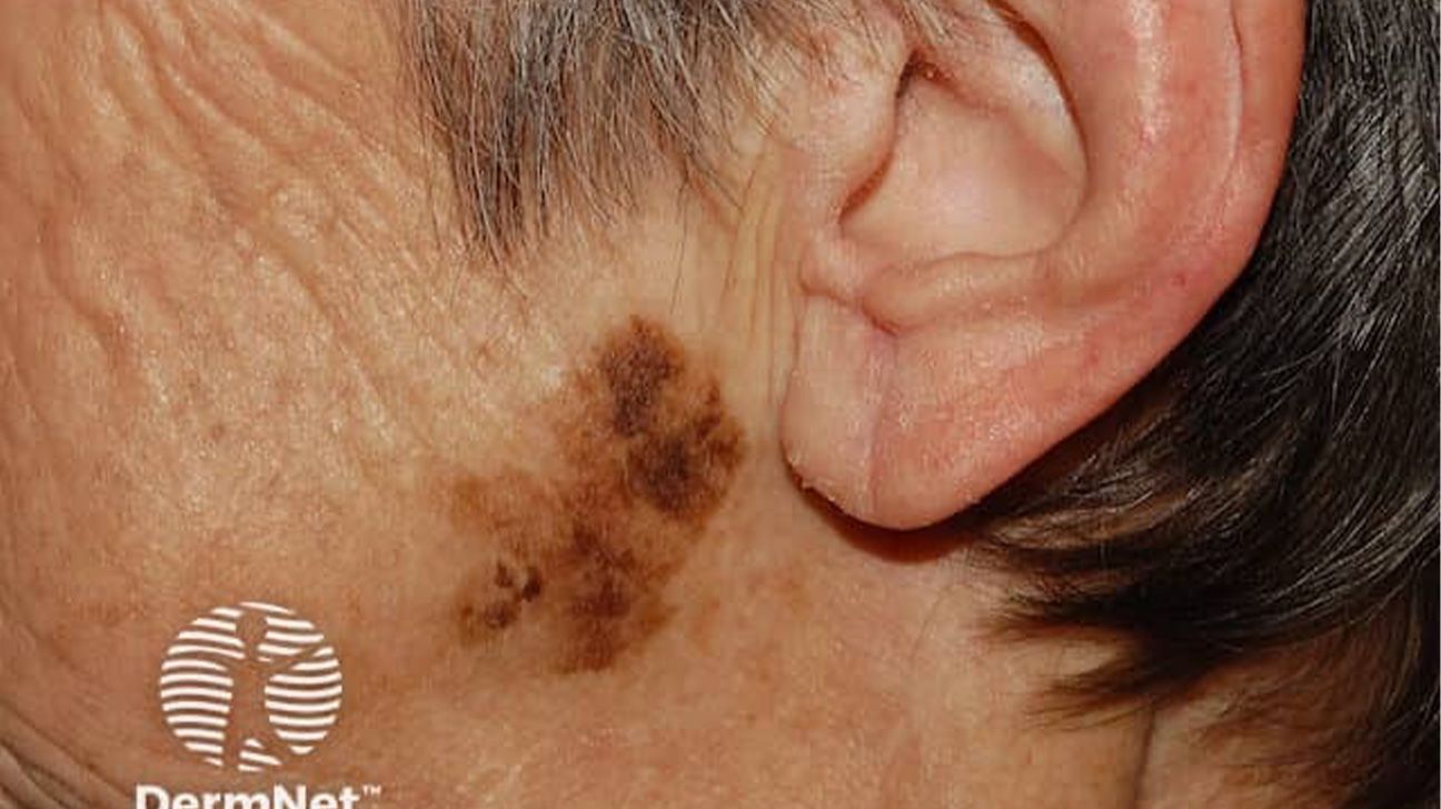 Skin Cancer Spots On Face