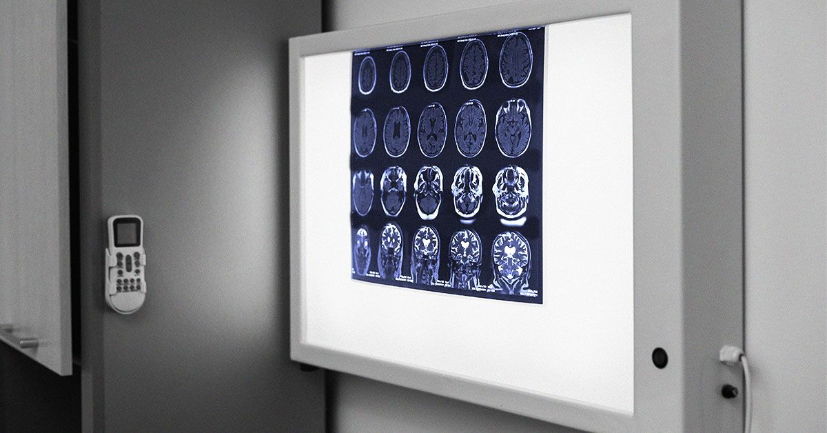 Understanding how epilepsy affects the nervous system
