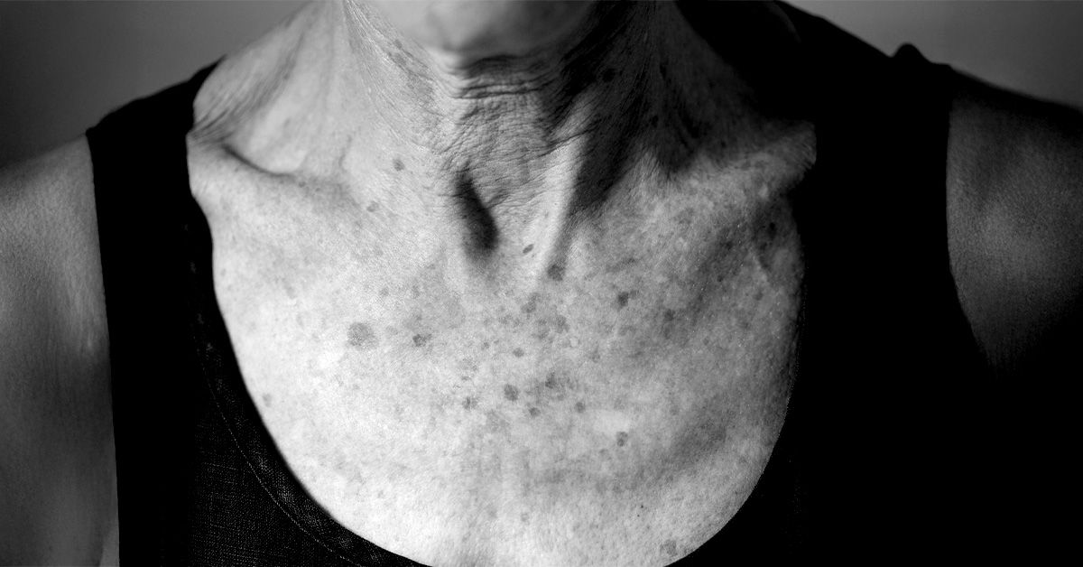 Age spots versus skin cancer: How to tell the difference