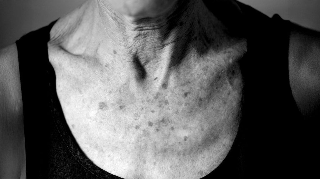 Age spots versus skin cancer: How to tell the difference