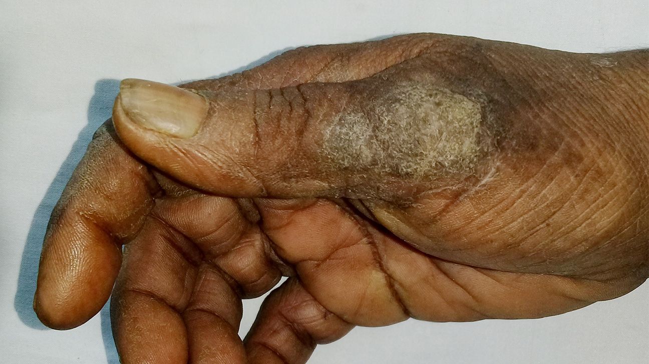 Ringworm On Black Face Types Of Tinea (Capitis, Corporis, Cruris,