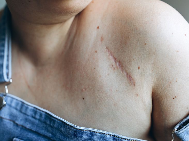 Skin cancer in scars