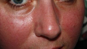 Red Face Blue Nose