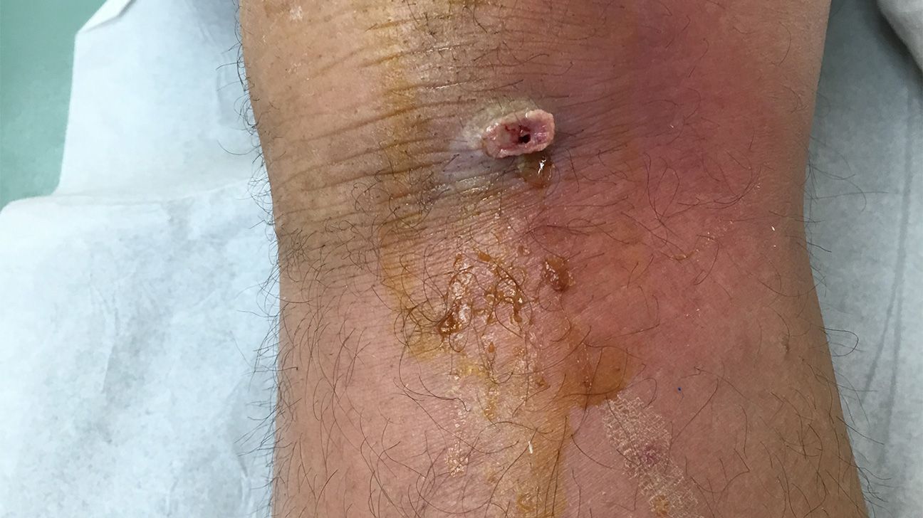 Staph Rash After Surgery