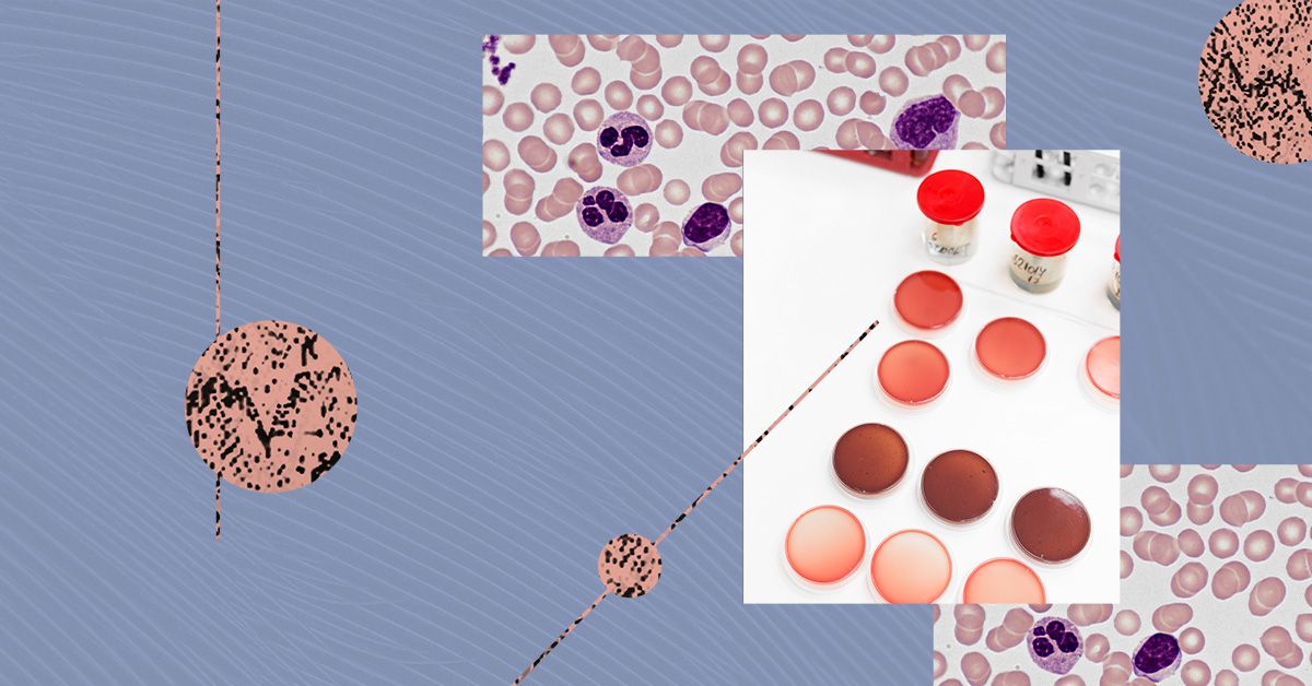 Multiple myeloma: All different types