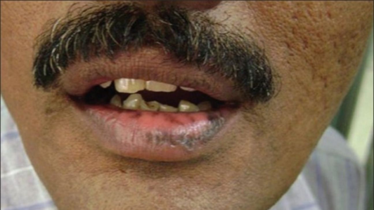 Causes Of Swelling Lips And Hives Reddit - Infoupdate.org