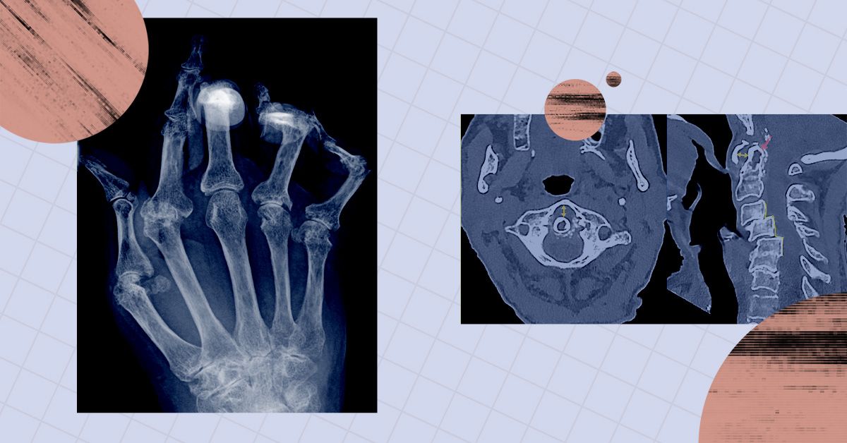 Rheumatoid arthritis radiology tests and diagnosis