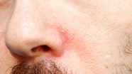 Dry Skin Between Eyes And Nose Infoupdate Dry Skin Between Eyes And Nose Infoupdate