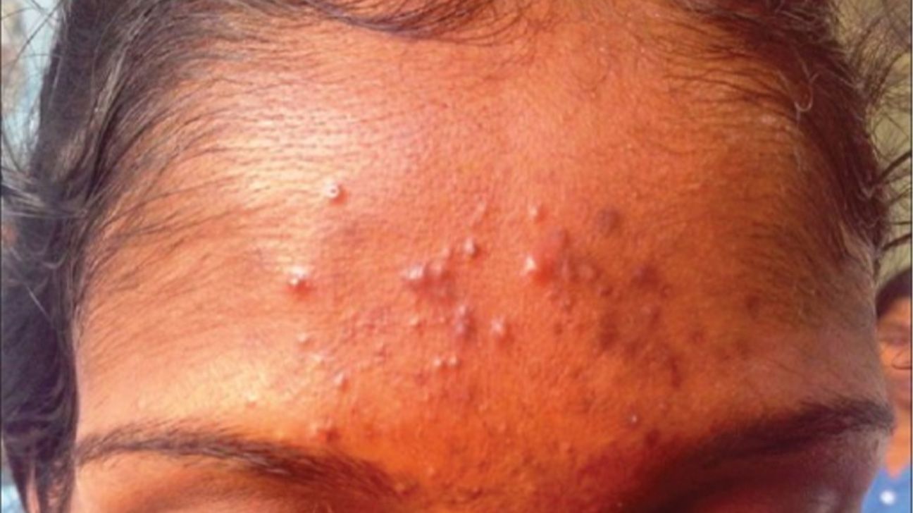 Whiteheads Acne Treatment NYC | Mount Sinai New York