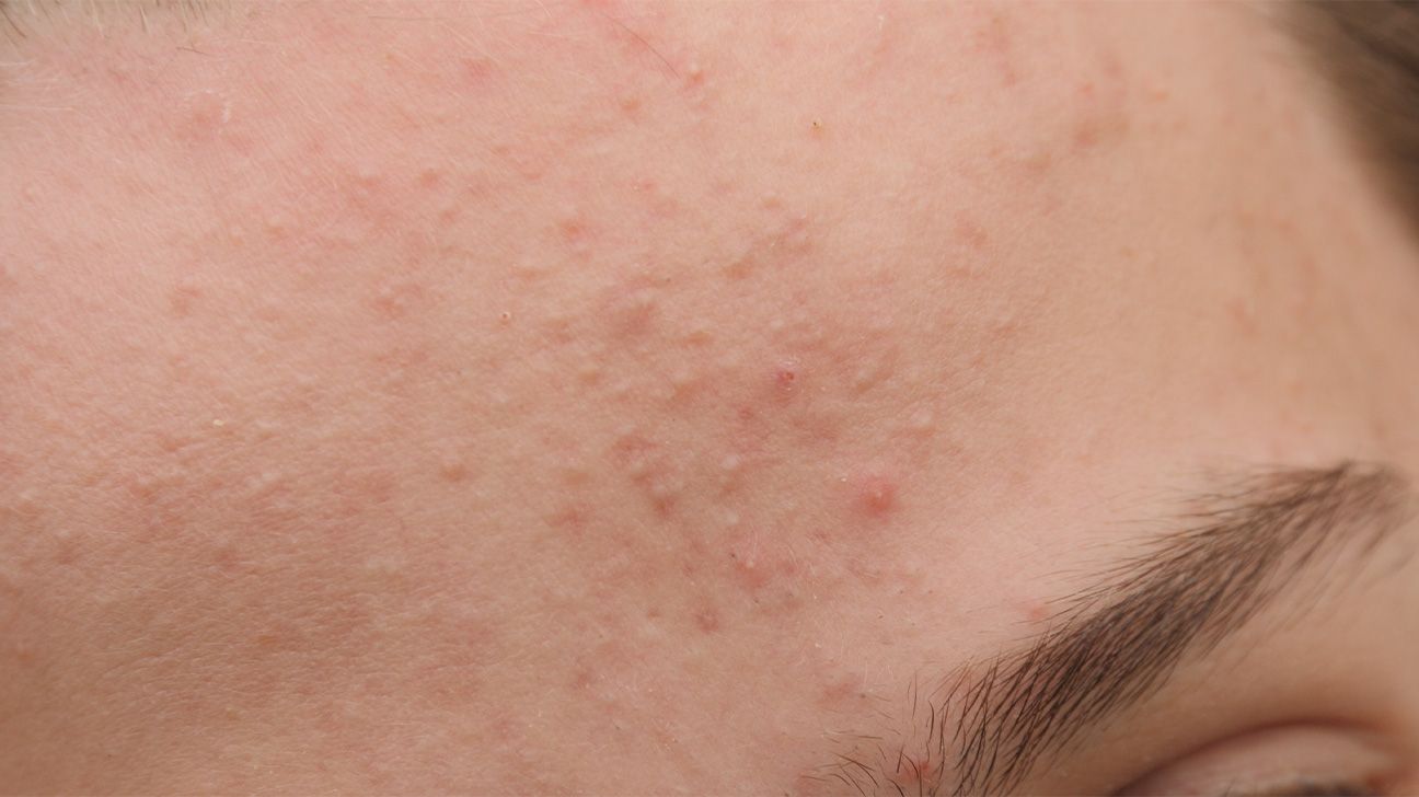 Whiteheads Acne Treatment NYC | Mount Sinai New York