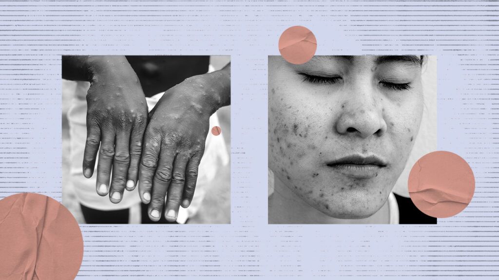 Monkeypox (mpox) and acne: Similarities and comparisons
