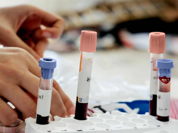 Graves' disease diagnosis: What tests do I need?