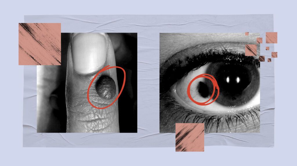 Blue Nevus Eyelid A Closer Look At Uveal Melanoma AIM At Melanoma