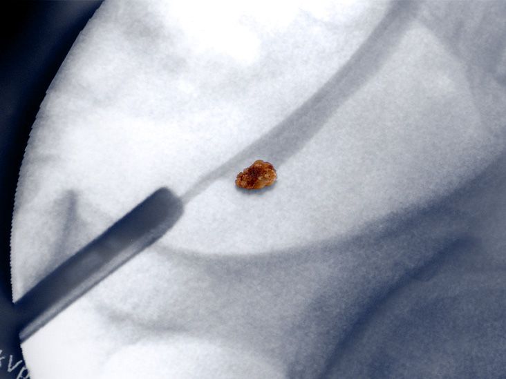 Kidney stones pictures: Visuals, symptoms, and treatment