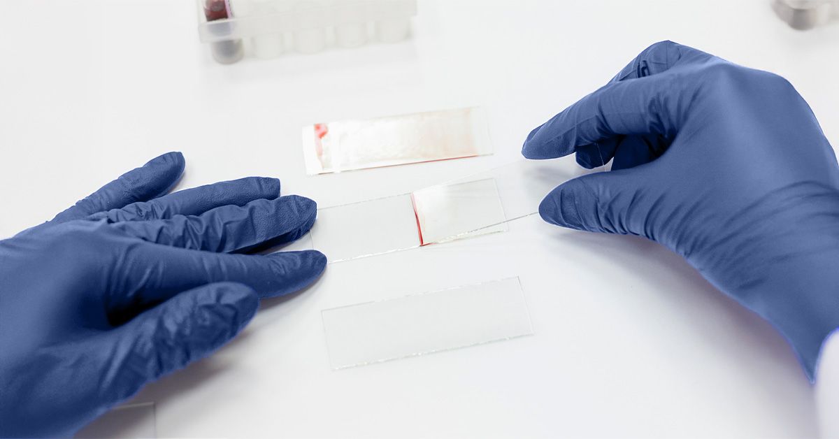 IgG4-related sclerosing disease: Symptoms, treatment, and more