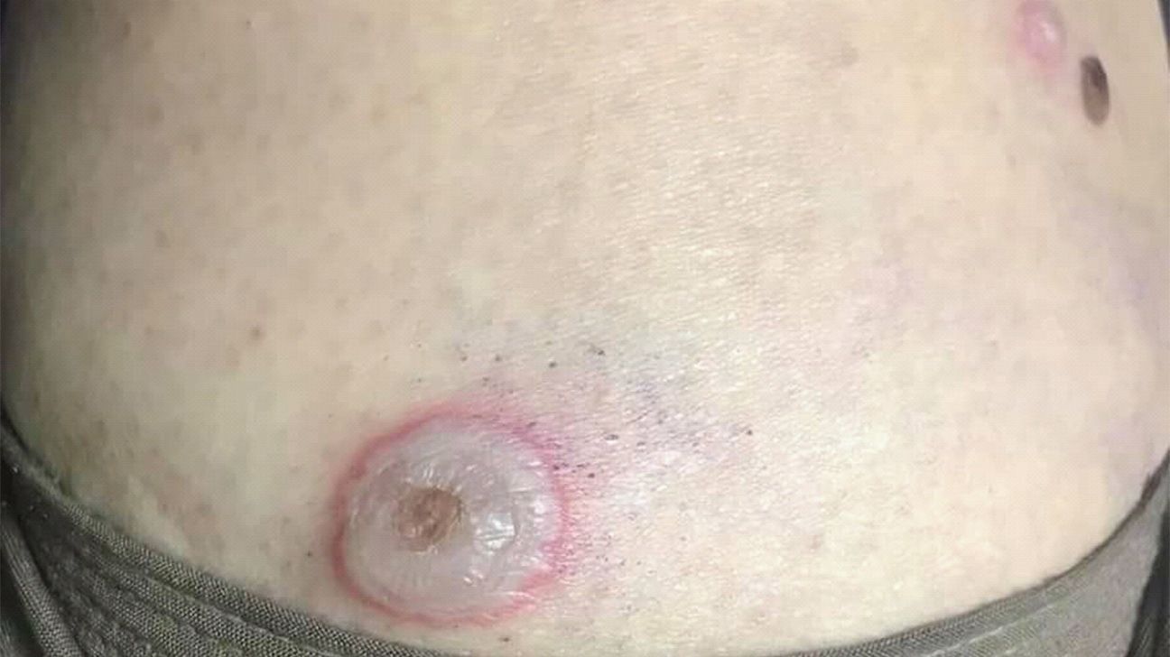 What Bites Cause Bullseye Rash