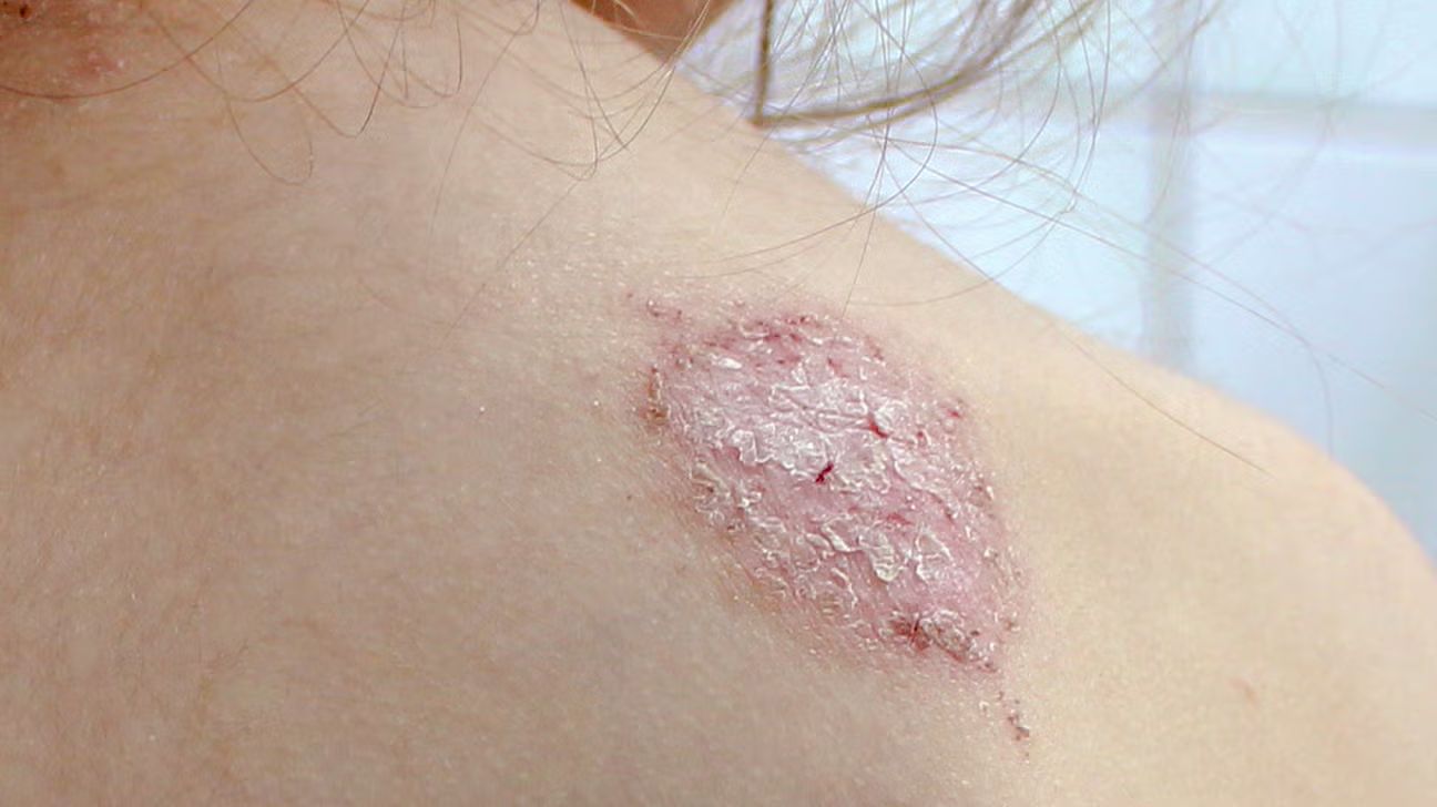 Eczema Numular Drug Induced Nummular Dermatitis. Hoogstra Medical