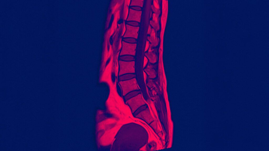 What is a spinal contusion?