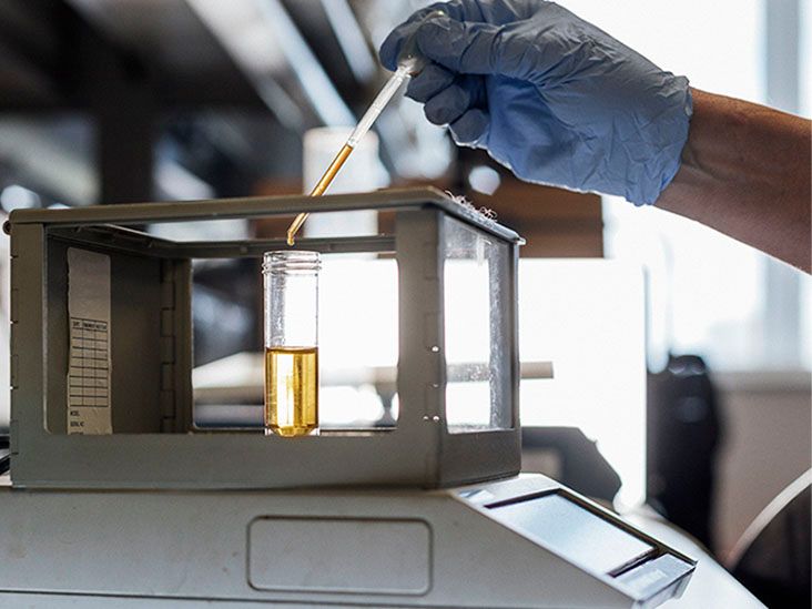 RBC in urine: What it means, ranges, and test results