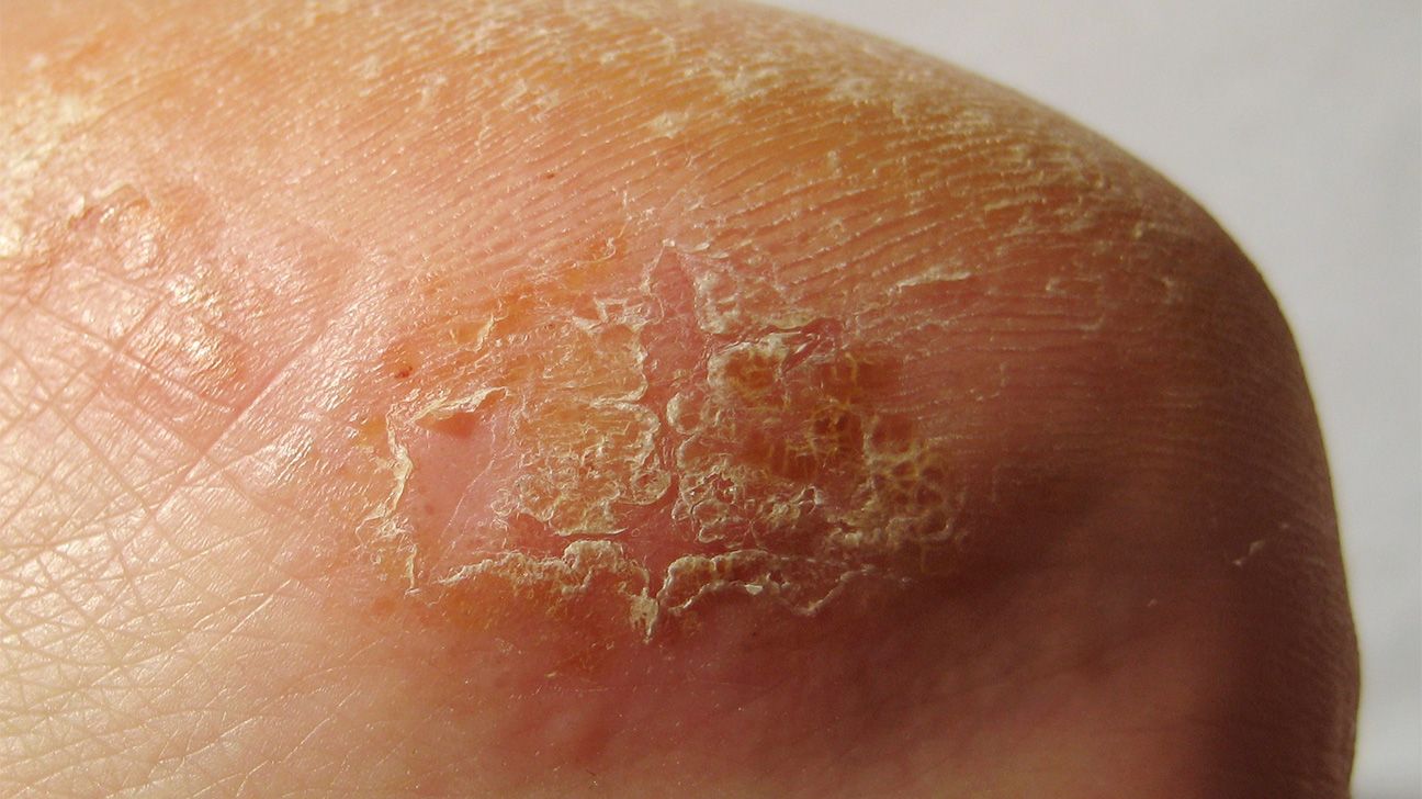 Rash On Feet Hand, Foot & Mouth Disease (HFMD): Symptoms & Causes