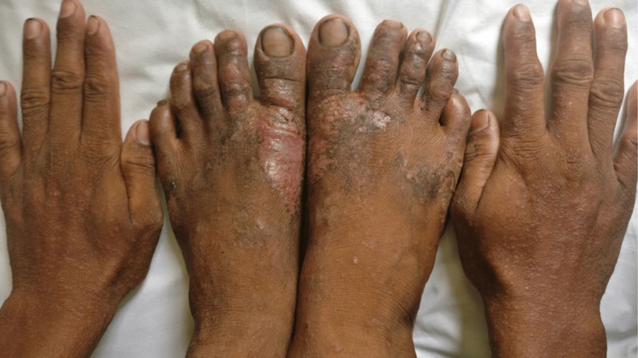 Irritant Contact Dermatitis Foot