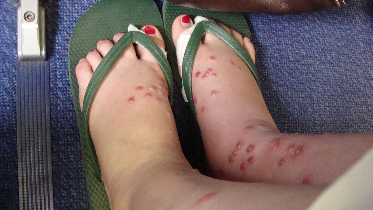 Poison Ivy Rash On Feet Maria's Nightmare Poison Ivy Rash