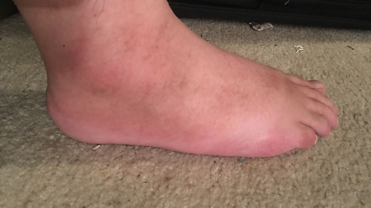 What Is A Skin Rash And How To Treat It Marietta Foot