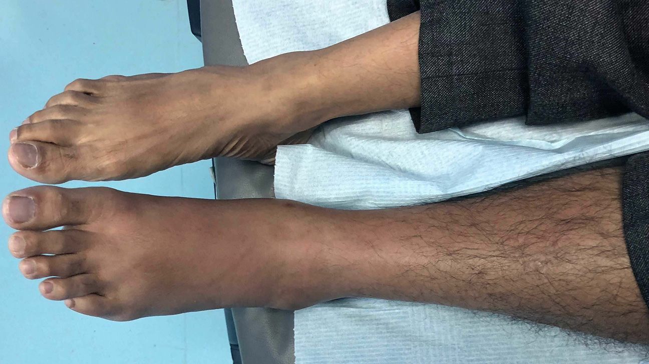 What Is A Skin Rash And How To Treat It Marietta Foot