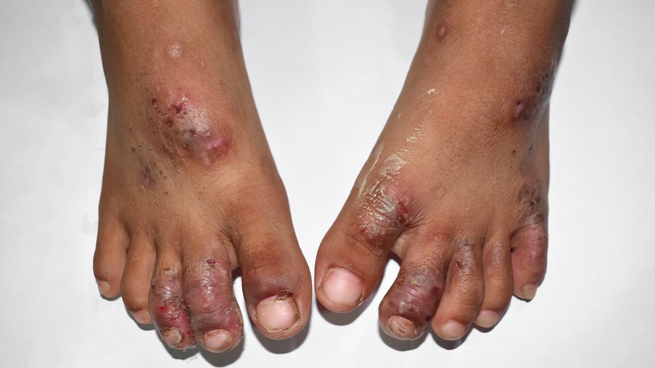What Is A Skin Rash And How To Treat It Marietta Foot
