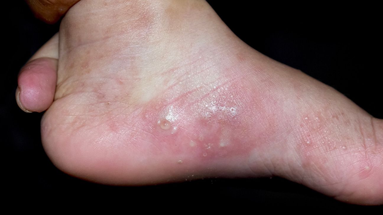 What Can Cause A Rash And Swollen Feet - Infoupdate.org