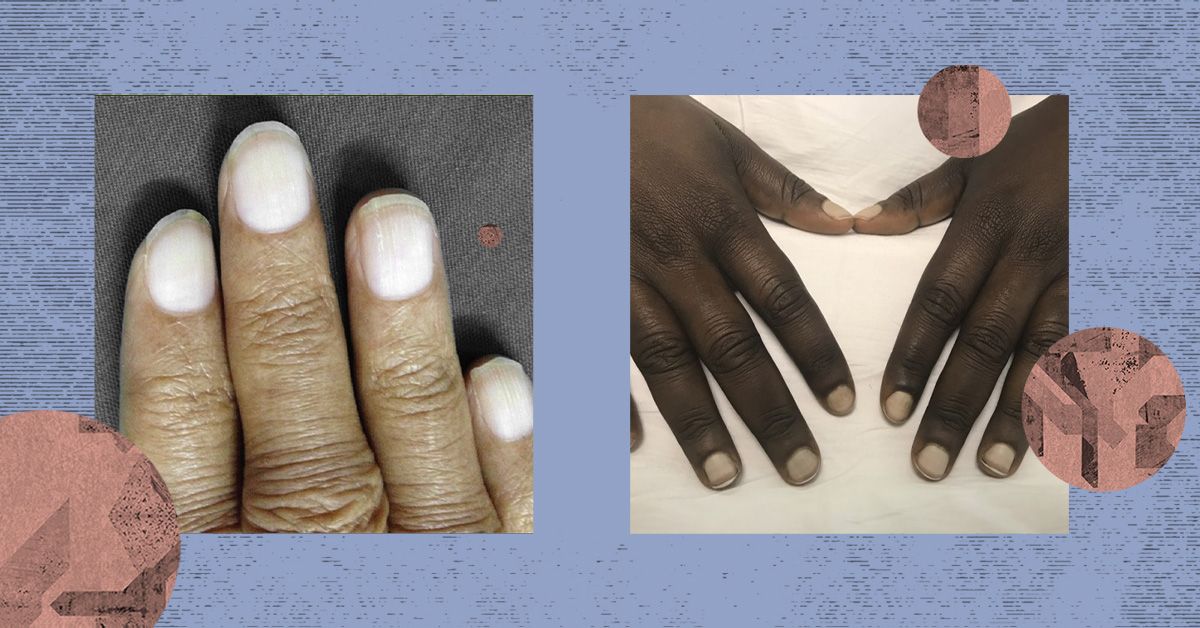 Terry's nails: Appearance, causes, and treatment
