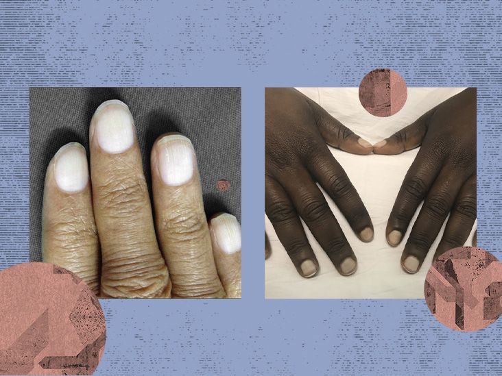 Terry's nails: Appearance, causes, and treatment