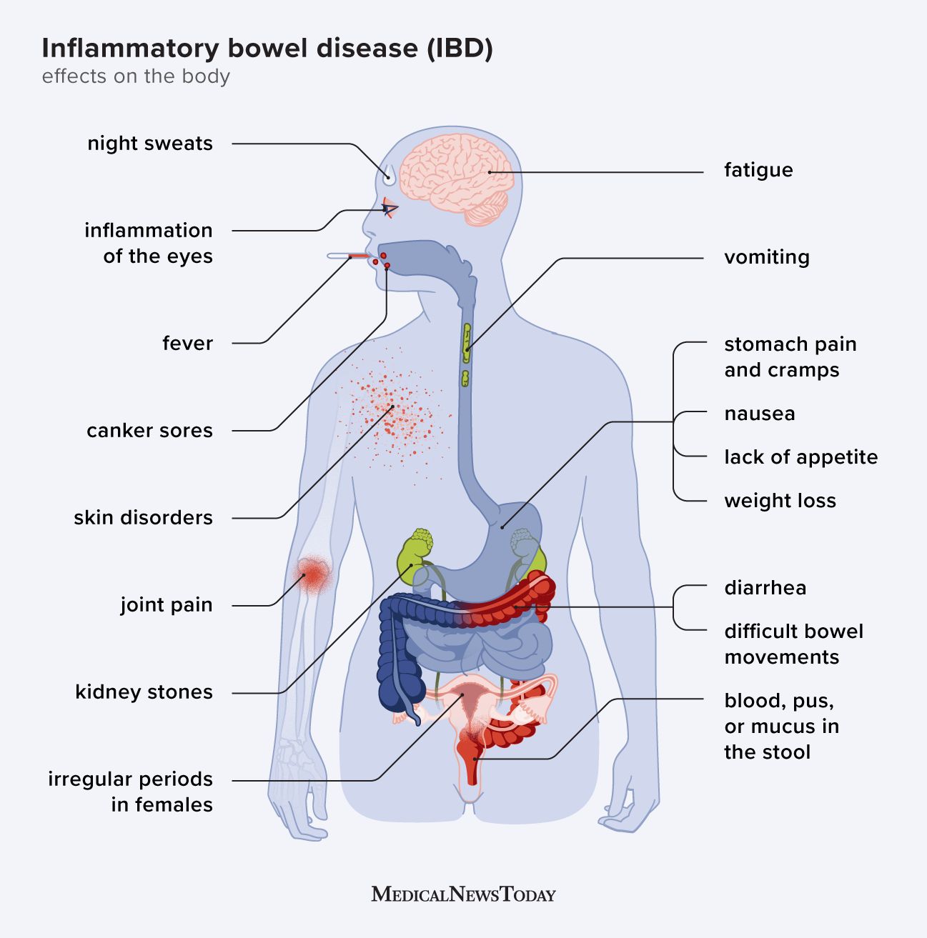 Irritable Bowel Syndrome Causes Signs Symptoms Diagnosis