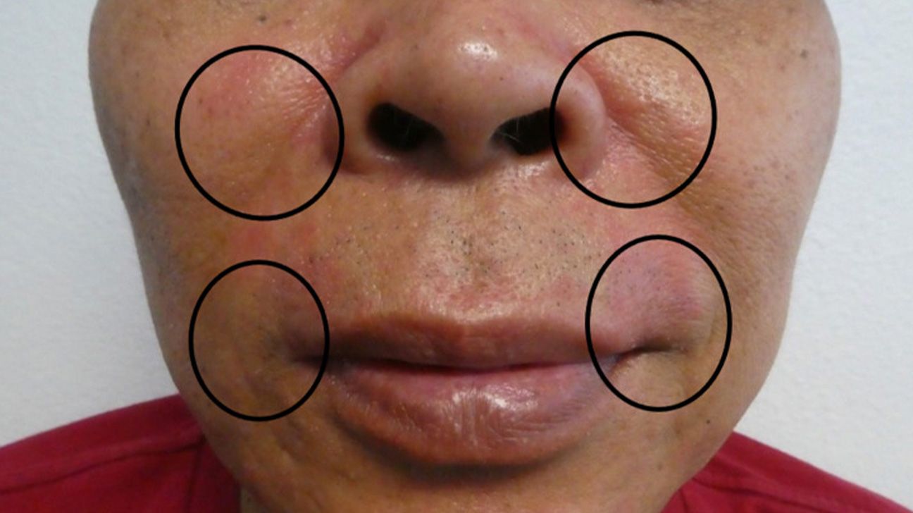 Mild Periorbital Dermatitis