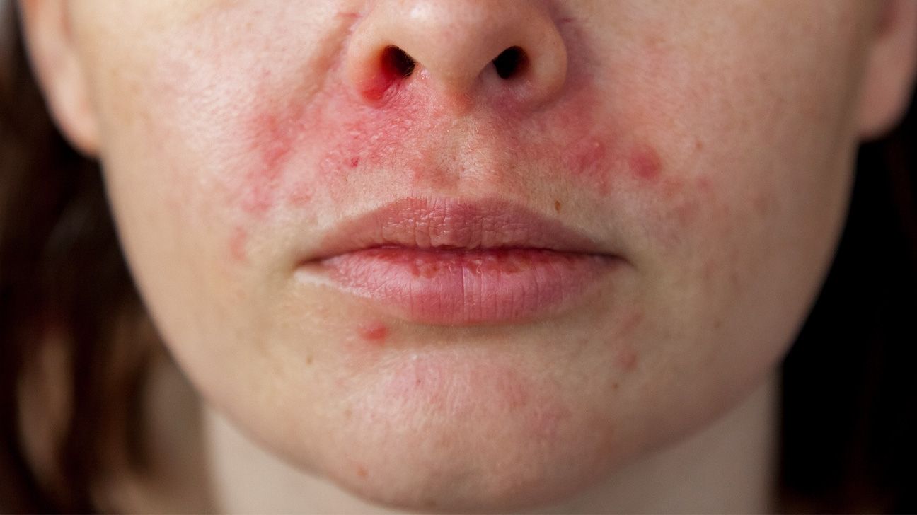 Red Burning Rash On Corners Of Mouth - Infoupdate.org