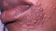 Why Do I Have Small Red Bumps Around My Mouth Infoupdate Why Do I Have Small Red Bumps Around My Mouth Infoupdate