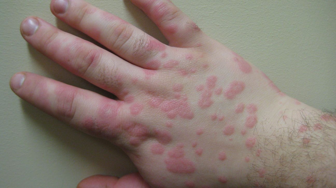 Skin Erythema