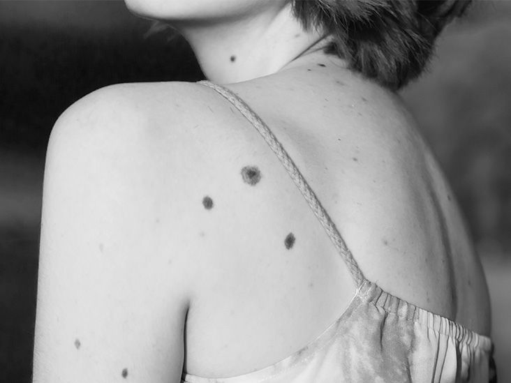 Itchy mole: Causes, treatment, and symptoms