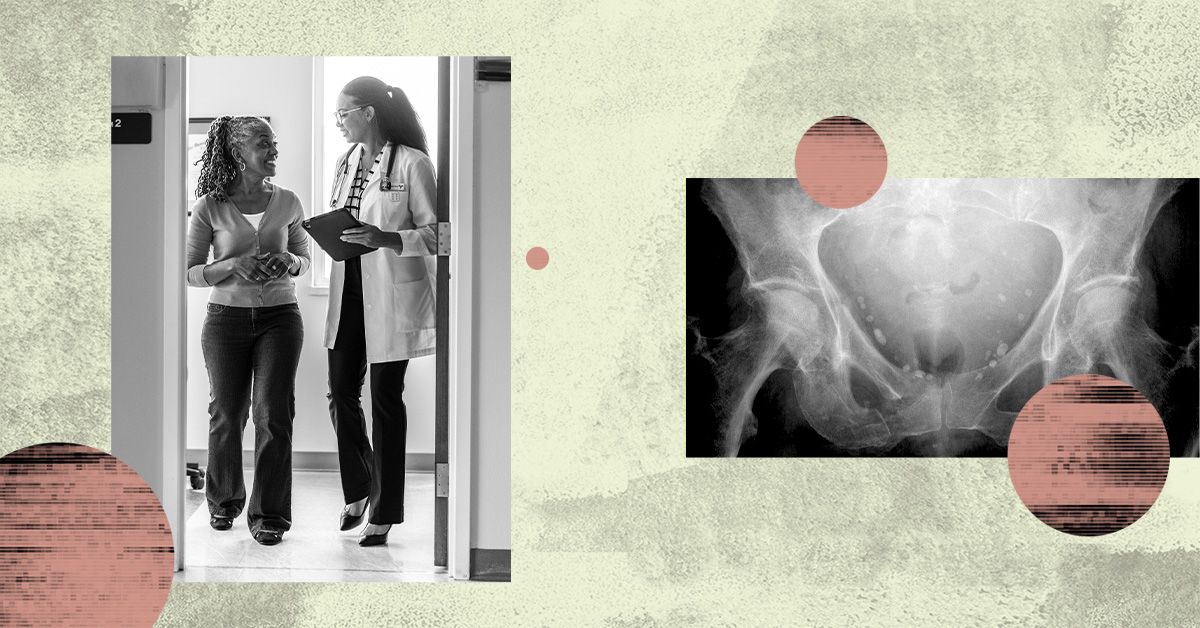 Phleboliths: Causes, symptoms, and treatment