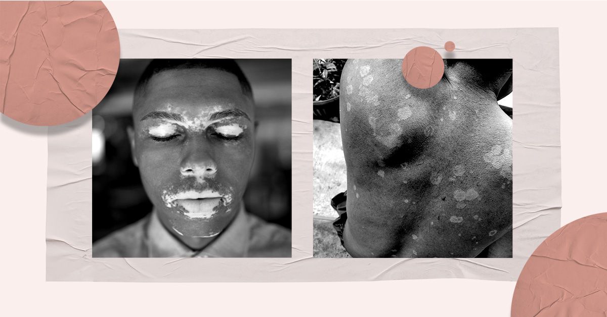 Skin pigmentation disorders: Types, diagnosis, and treatment