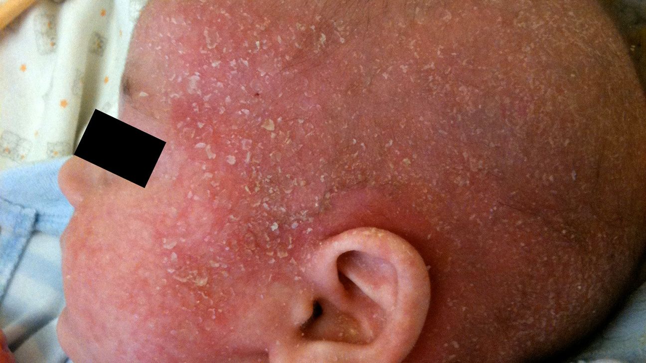 Food Allergy Rash On Face - Infoupdate.org