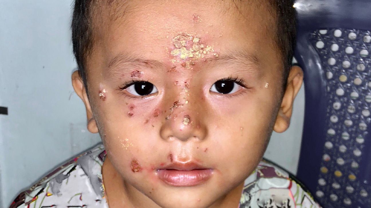Impetigo Nostril