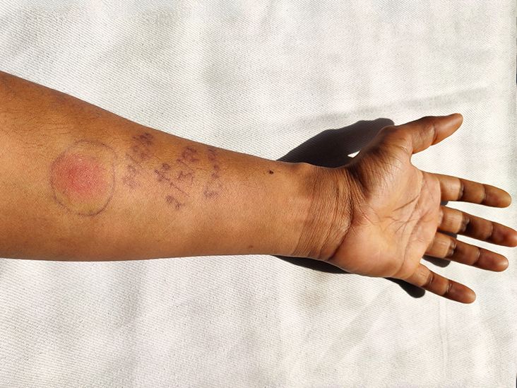 Medicare and coverage for a PPD test: What to know