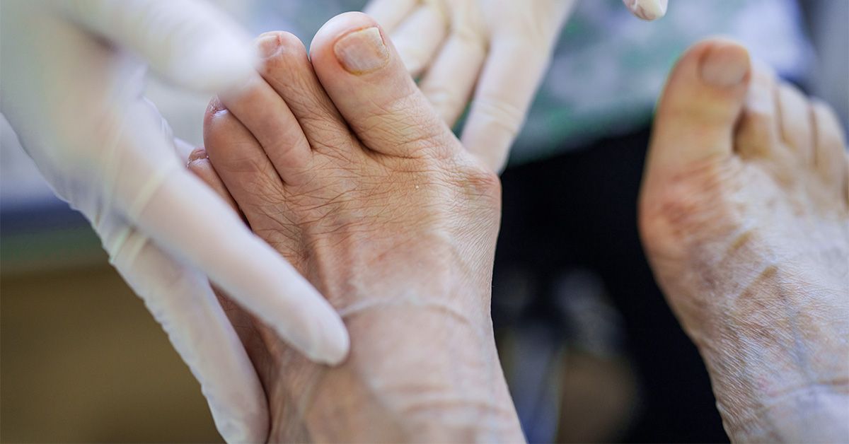 Gout: Symptoms, causes, and treatment